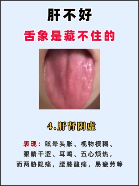 肝胆湿热吃什么药最好_肝胆湿热吃什么中成药-第1张图片-山城妙识 肝胆湿热吃什么药最好_肝胆湿热吃什么中成药-第1张图片-山城妙识