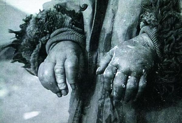 芥子气是什么_芥子气中毒怎么办-第1张图片-山城妙识 芥子气是什么_芥子气中毒怎么办-第1张图片-山城妙识