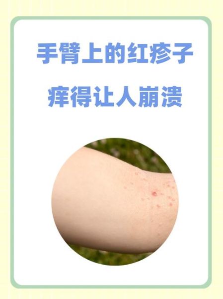 身上起红疹子很痒怎么办_常见疹子症状图片对照-第3张图片-山城妙识