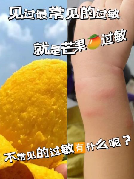 芒果过敏症状有哪些_吃了芒果多久会起反应-第2张图片-山城妙识
