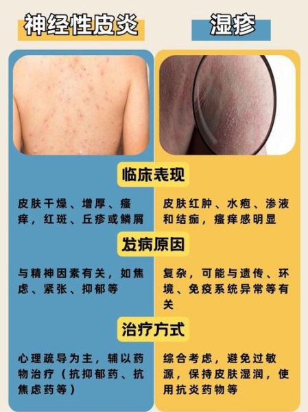 皮炎和湿疹的区别图片_怎么分辨-第2张图片-山城妙识