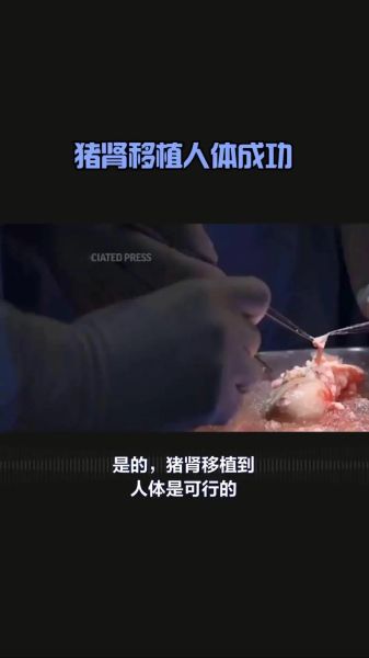 猪肾移植人体最新进展_猪肾移植人体能活多久-第1张图片-山城妙识 猪肾移植人体最新进展_猪肾移植人体能活多久-第1张图片-山城妙识