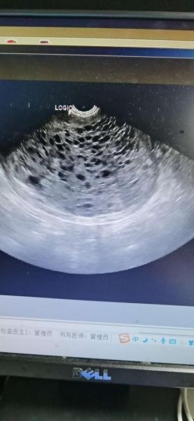 葡萄胎图片什么样子_典型特征有哪些-第1张图片-山城妙识