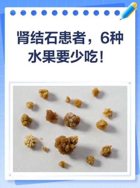 肾结石吃什么水果_肾结石不能吃什么水果-第2张图片-山城妙识