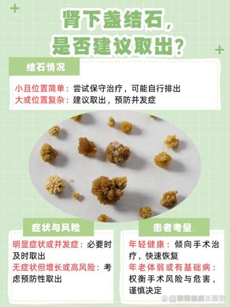 肾结石的早期症状_如何判断自己有肾结石-第3张图片-山城妙识 肾结石的早期症状_如何判断自己有肾结石-第3张图片-山城妙识