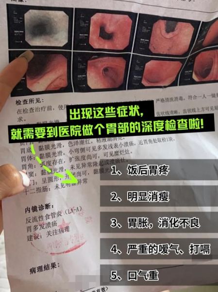 胃溃疡一般多久自愈_胃溃疡多久能好-第1张图片-山城妙识