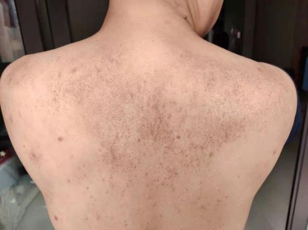 淀粉样变心肌病早期症状_淀粉样变心肌病能活多久-第1张图片-山城妙识