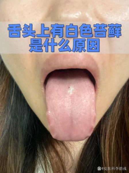 胃癌早期舌头图片_舌苔厚白是胃癌吗-第3张图片-山城妙识