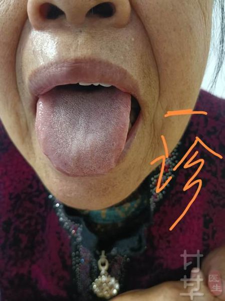 胃癌早期舌头图片_舌苔厚白是胃癌吗-第2张图片-山城妙识