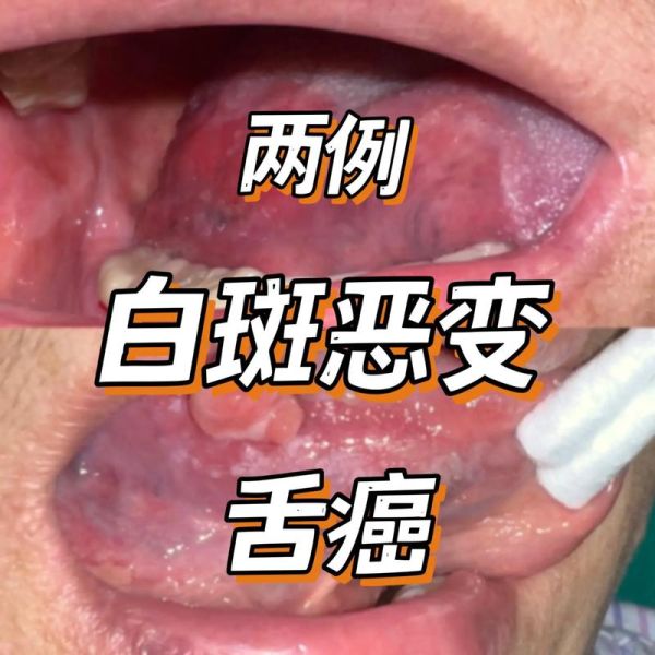 胃癌早期舌头图片_舌苔厚白是胃癌吗-第1张图片-山城妙识