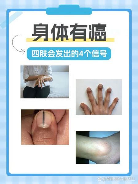 体内有癌的早期症状_如何判断体内有癌-第1张图片-山城妙识