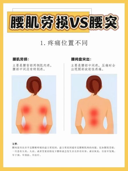 腰肌劳损怎么判断_腰肌劳损的症状有哪些-第1张图片-山城妙识