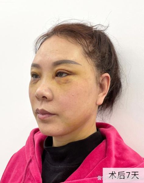 脸部拉皮手术过程图片_恢复期多久-第1张图片-山城妙识