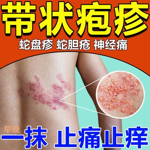 蛇胆疮怎么治疗好得快_蛇胆疮用什么药最有效-第1张图片-山城妙识