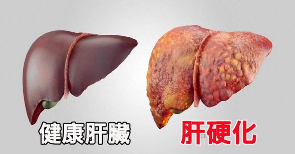 肝硬化可以治愈吗_肝硬化能逆转吗-第1张图片-山城妙识