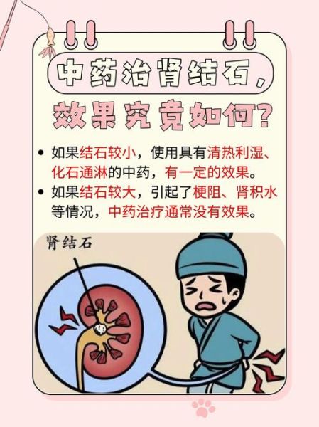 小苏打治疗肾结石_肾结石自然疗法-第1张图片-山城妙识