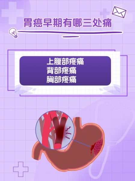 女性胃癌前期五个身体信号_早期有哪些症状-第2张图片-山城妙识