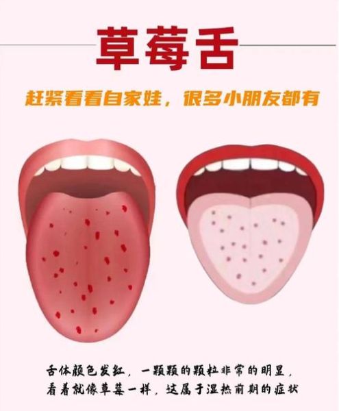 草莓舌头是什么原因_草莓舌头是缺什么维生素-第1张图片-山城妙识