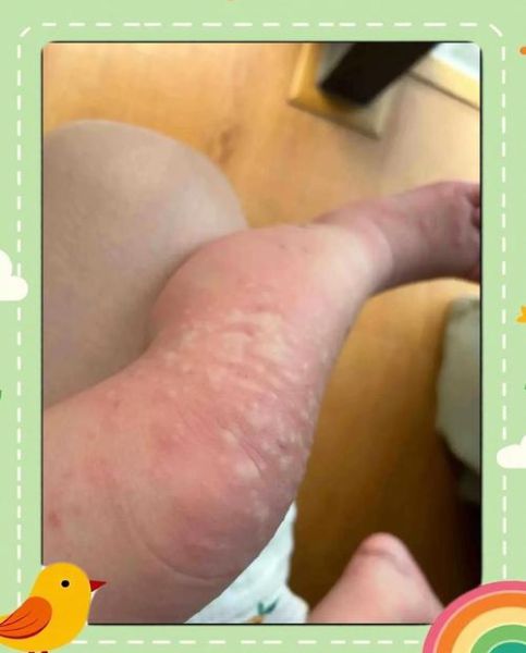 淮山过敏手痒怎么办_处理淮山手痒最快方法-第2张图片-山城妙识