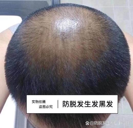 飞机打多了会脱发吗_多久能恢复-第1张图片-山城妙识