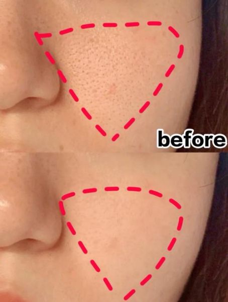 芝麻毛孔粗大怎么办_如何改善芝麻毛孔-第3张图片-山城妙识