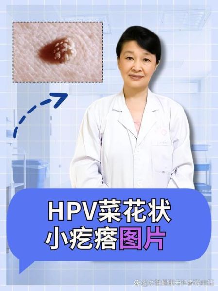 男性菜花状疣不痛不痒_会自愈吗-第2张图片-山城妙识