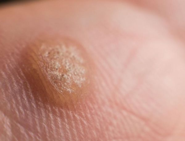 男性菜花状疣不痛不痒_会自愈吗-第3张图片-山城妙识