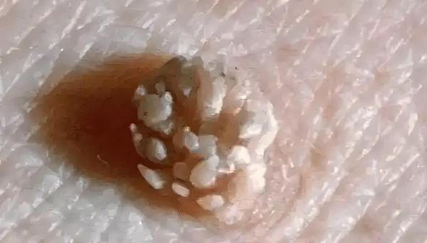 男性菜花状疣不痛不痒_会自愈吗-第1张图片-山城妙识