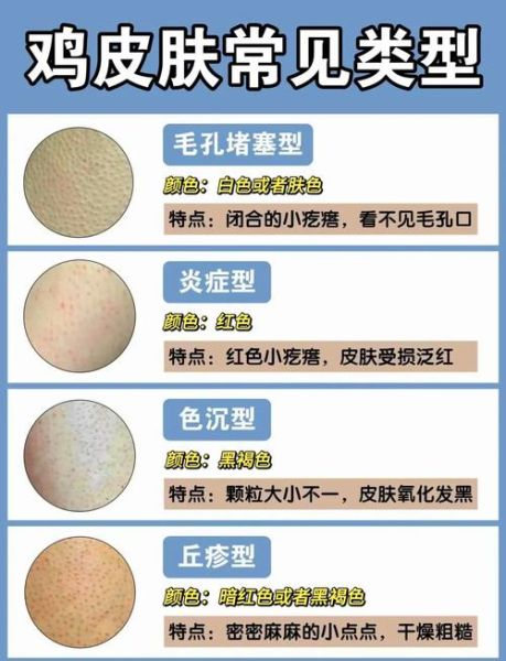 鸡皮肤怎么消除最有效_手臂鸡皮肤怎么改善-第1张图片-山城妙识