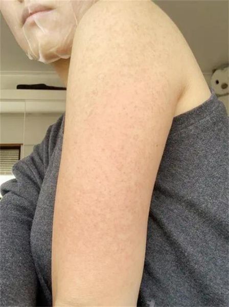 鸡皮肤怎么消除最有效_手臂鸡皮肤怎么改善-第3张图片-山城妙识