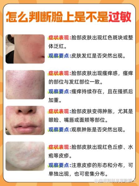 皮肤过敏症状图片_怎么判断是不是过敏-第1张图片-山城妙识