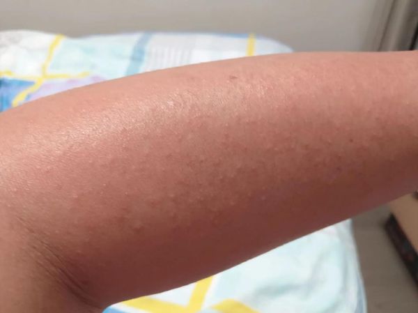 皮肤过敏症状图片_怎么判断是不是过敏-第3张图片-山城妙识