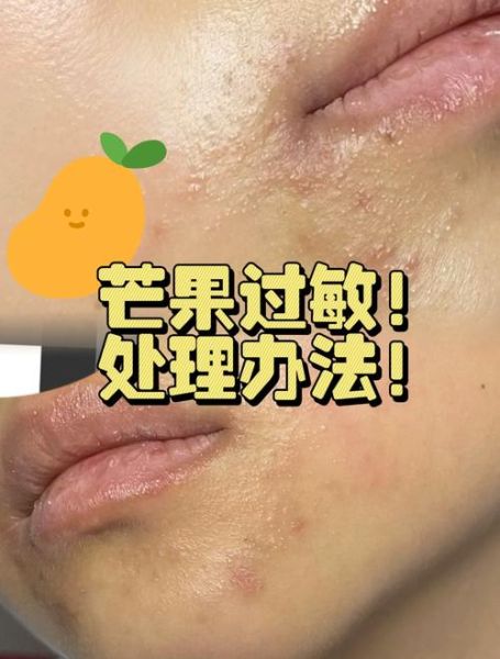 芒果过敏一天比一天严重怎么办_芒果过敏症状加重原因-第1张图片-山城妙识