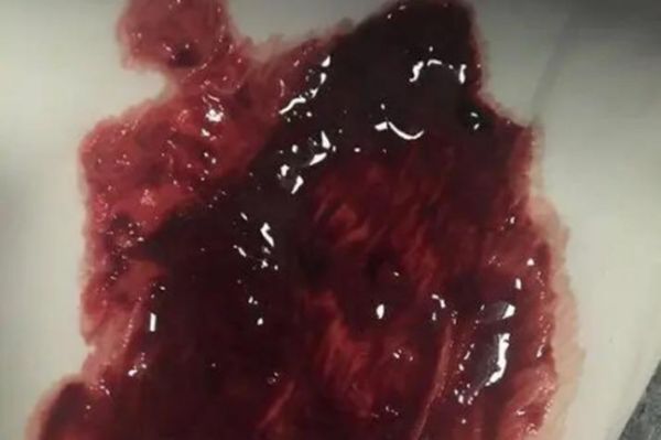 大便出血鲜红色不痛不痒怎么回事_需要看医生吗-第3张图片-山城妙识