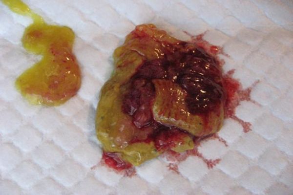 大便出血鲜红色不痛不痒怎么回事_需要看医生吗-第2张图片-山城妙识