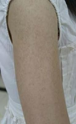 鱼鳞病图片_鱼鳞病初期症状图片-第2张图片-山城妙识