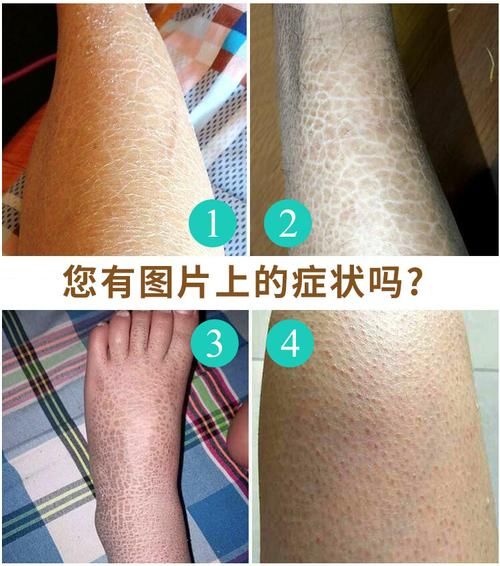 鱼鳞病图片_鱼鳞病初期症状图片-第1张图片-山城妙识