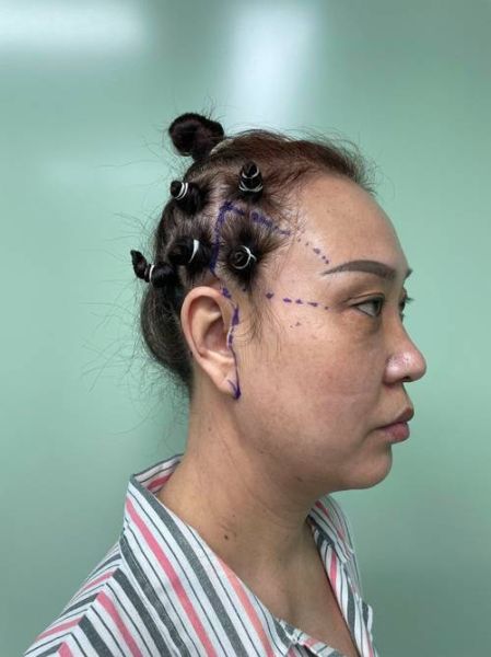 拉皮手术是怎么做的_拉皮手术全过程-第1张图片-山城妙识