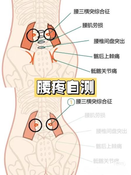 腰往下一点屁股上面那段疼是怎么回事_久坐腰疼屁股上方疼怎么缓解-第2张图片-山城妙识
