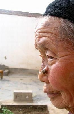 莲蓬乳芝麻毛孔怎么去除_莲蓬乳芝麻毛孔会自愈吗-第2张图片-山城妙识