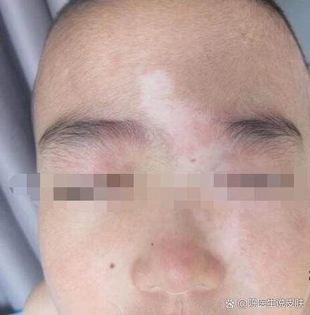 缺锌脸上白斑图片_缺锌白斑怎么消除-第1张图片-山城妙识