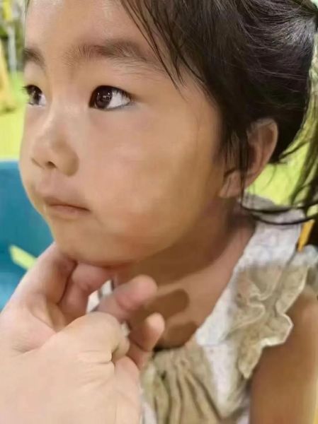 缺锌脸上白斑图片_缺锌白斑怎么消除-第3张图片-山城妙识