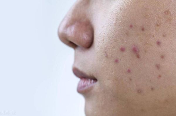 内分泌失调长痘怎么办_如何调理-第2张图片-山城妙识 内分泌失调长痘怎么办_如何调理-第2张图片-山城妙识