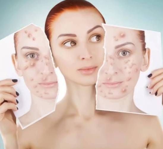 内分泌失调长痘怎么办_如何调理-第3张图片-山城妙识 内分泌失调长痘怎么办_如何调理-第3张图片-山城妙识