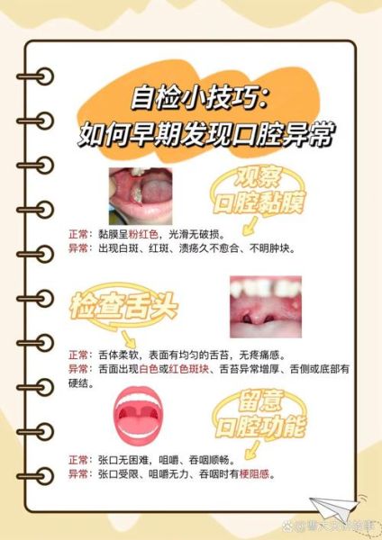 口腔溃疡反复不愈_警惕口腔癌前病变-第2张图片-山城妙识 口腔溃疡反复不愈_警惕口腔癌前病变-第2张图片-山城妙识