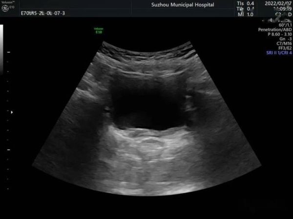 马蹄肾超声表现_马蹄肾超声能确诊吗-第2张图片-山城妙识