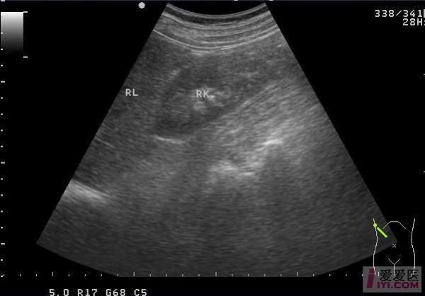 马蹄肾超声表现_马蹄肾超声能确诊吗-第3张图片-山城妙识