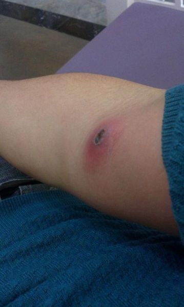 疖子没出脓有个硬疙瘩_多久能消-第1张图片-山城妙识