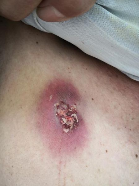 疖子没出脓有个硬疙瘩_多久能消-第2张图片-山城妙识