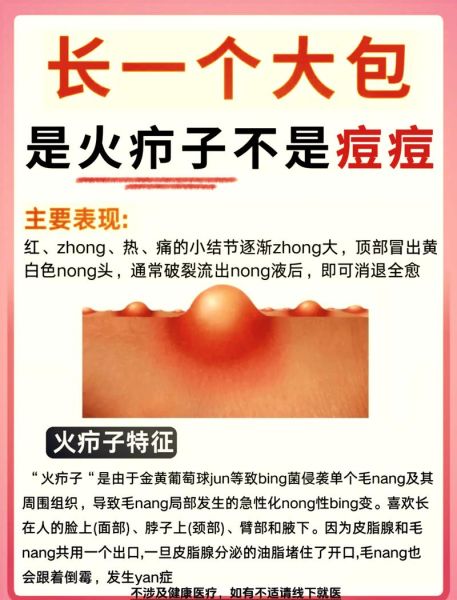 疖子没出脓有个硬疙瘩_多久能消-第3张图片-山城妙识